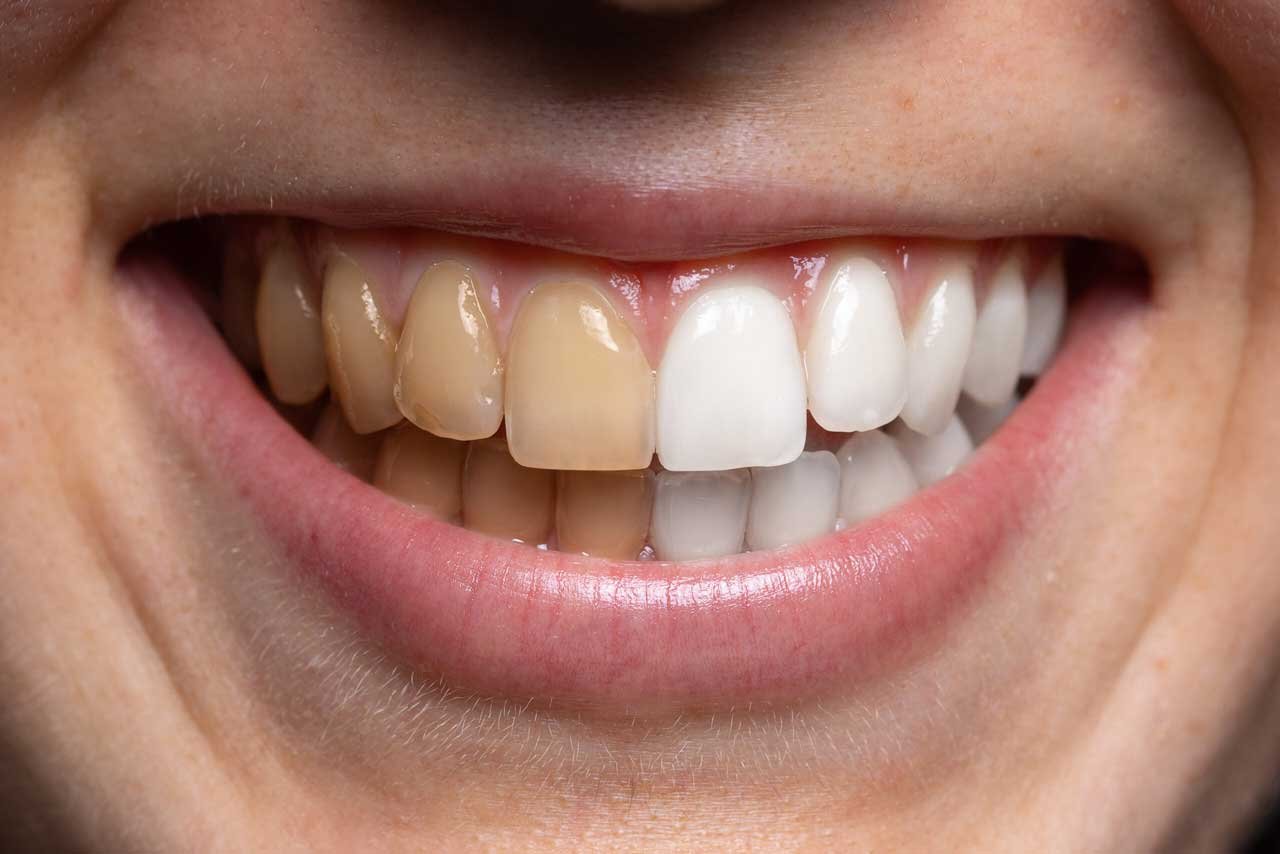 Types Of Teeth Whitening-A Complete Guide - Piethis